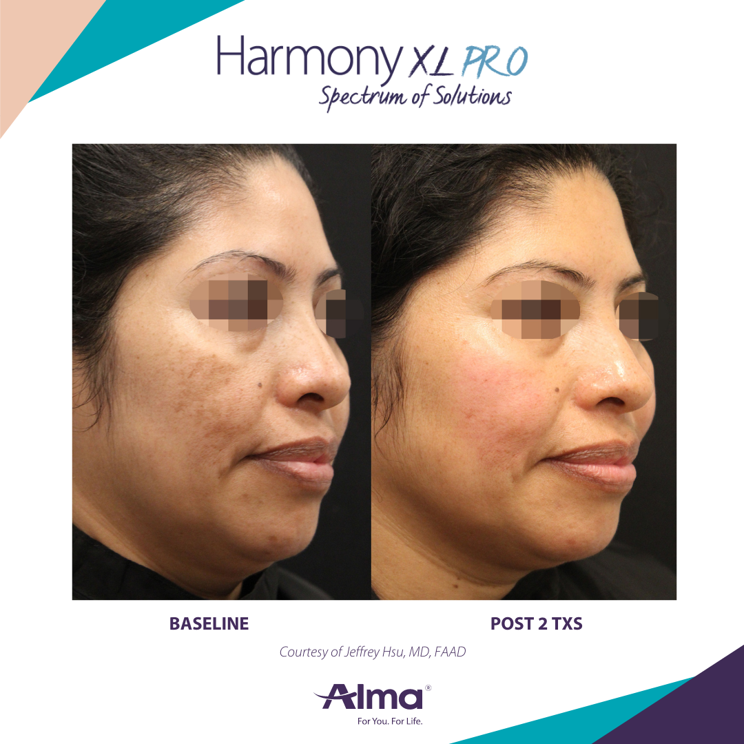 Alma ClearLift Pensacola, FL