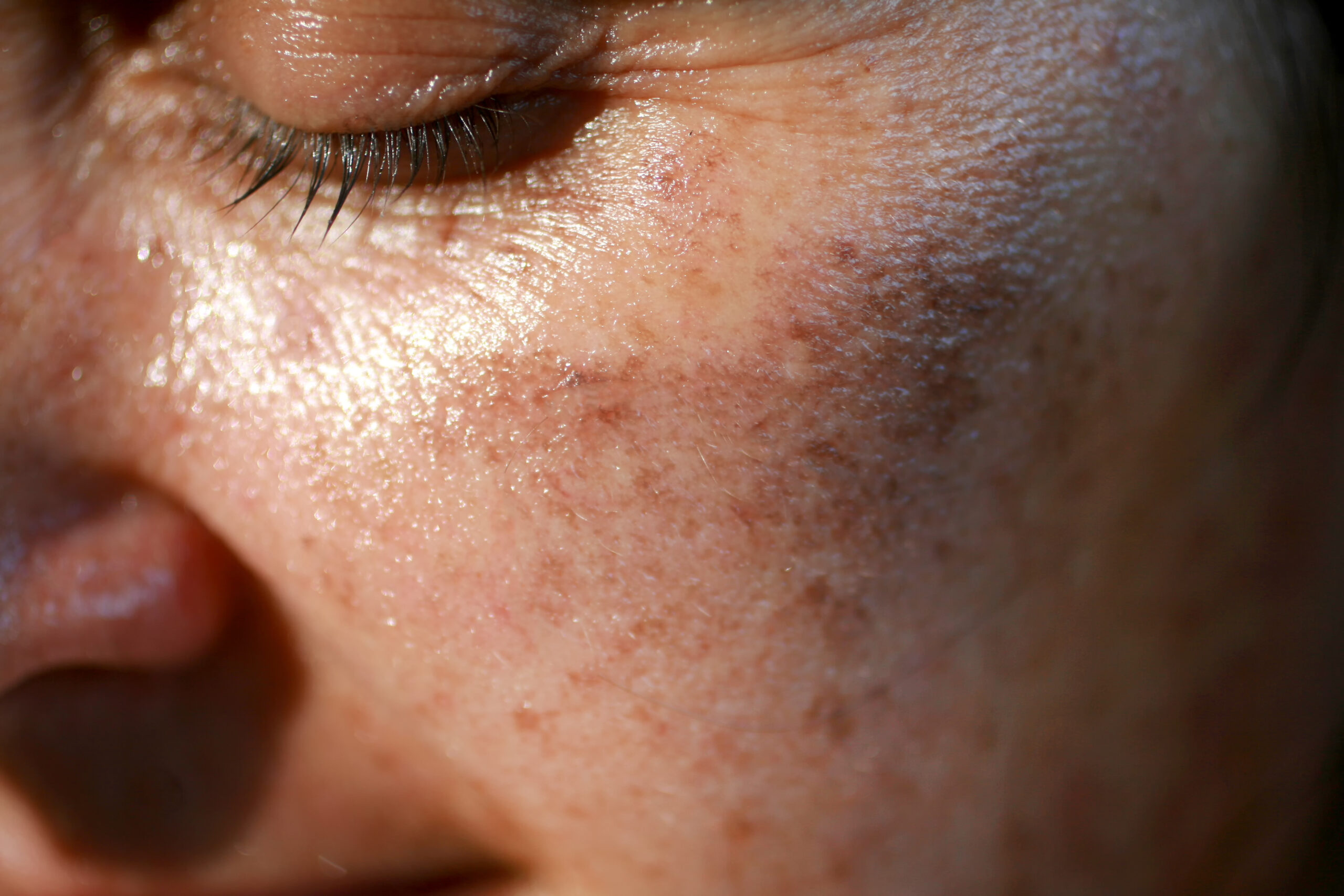 Addressing Sun Damage & Aging with Erbium Laser - Grace + Grey Spa